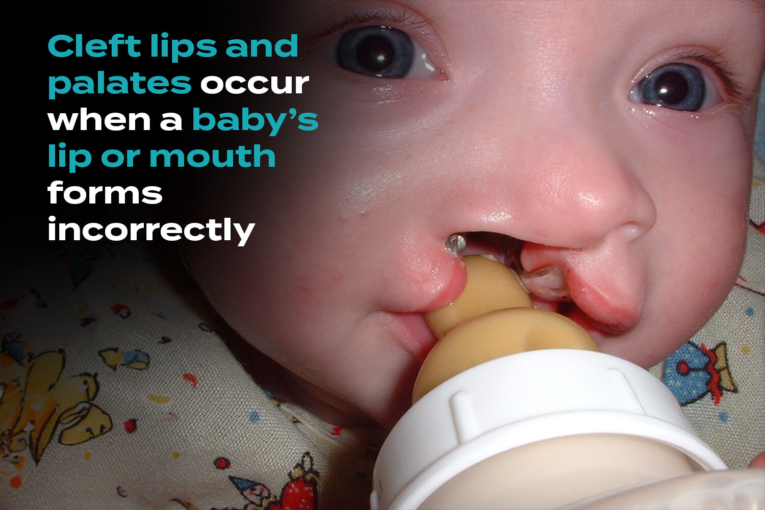 Interesting Facts About Cleft Palate - Infoupdate.org