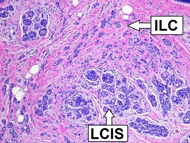 Invasive Lobular Carcinoma Invasive Lobular Carcinoma Mimicking