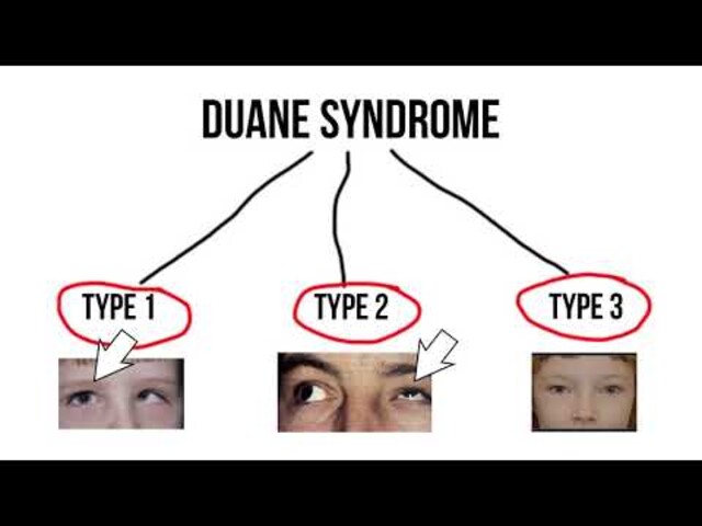 Duane Syndrome Karyotype Duane Syndrome American Association For