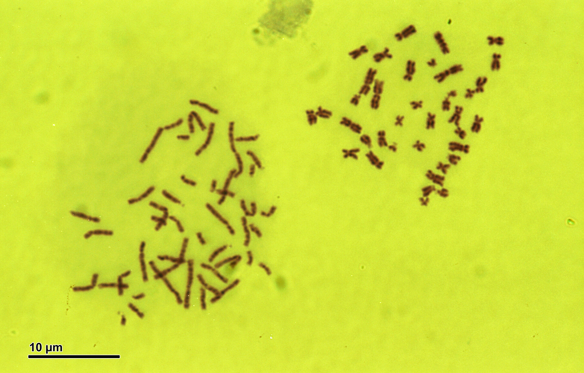 Diploid Triploid Mosaicism Storymd