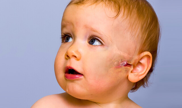 Figure 1 From There Is Something In The Ear Mondini Dysplasia