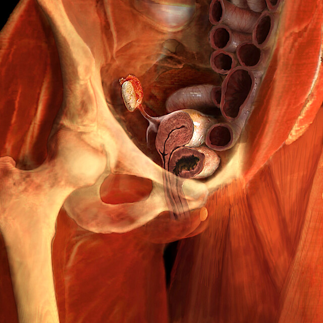 Urinary Tract Infection Armando Hasudungan Pregnancy (not A Disease)