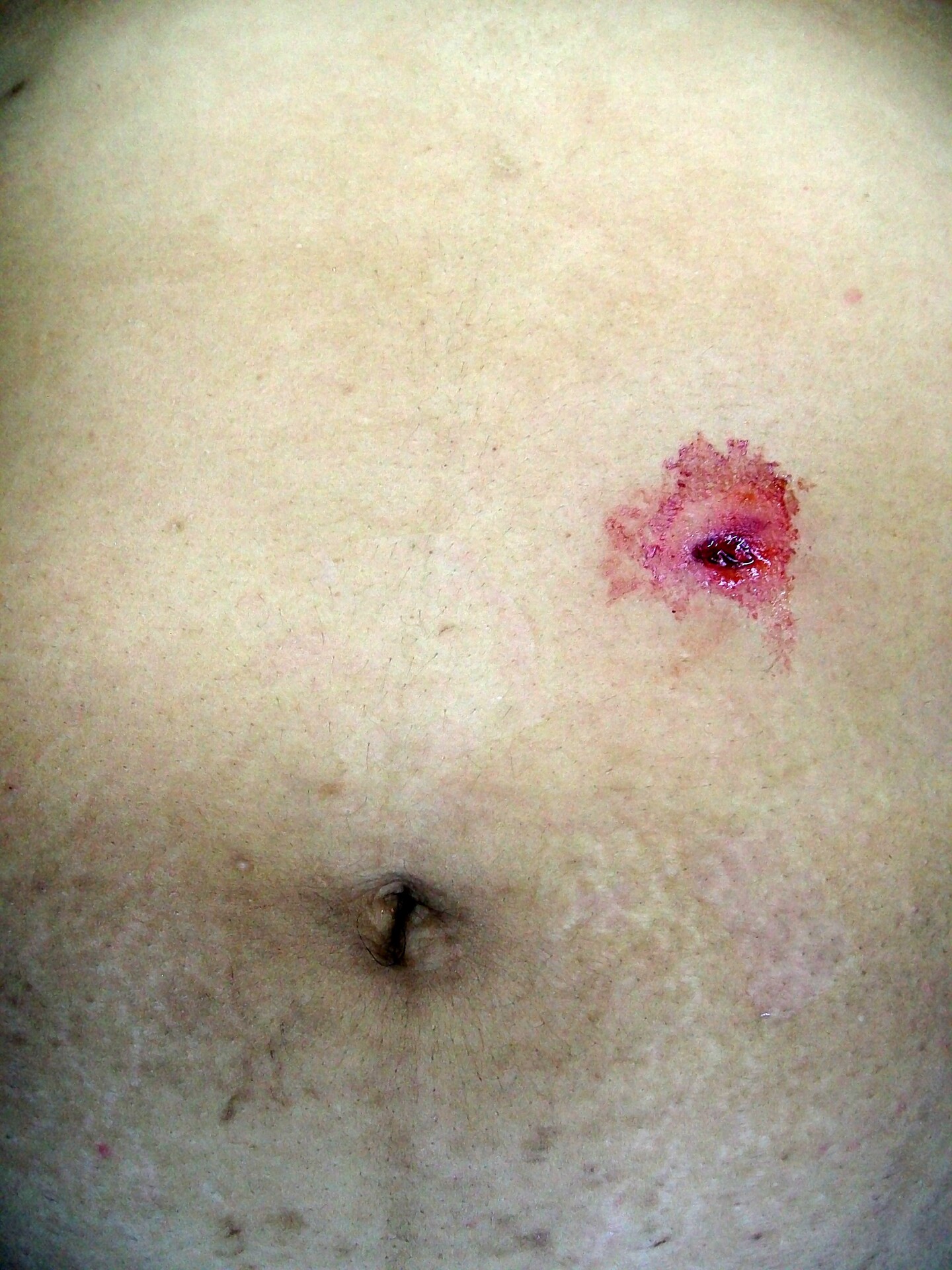 How Long Does A Bullet Hole Take To Heal