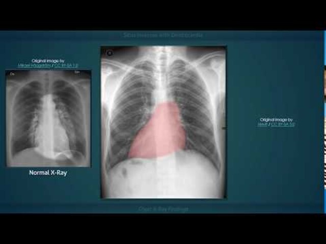 Dextrocardia