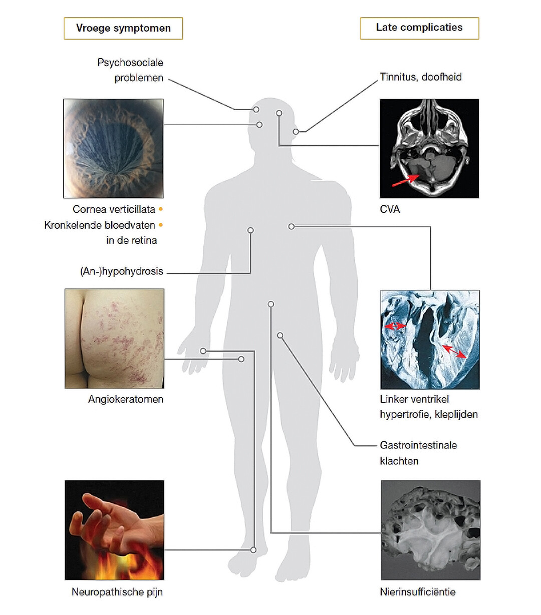 Fabrys Disease Symptoms Fabry Disease