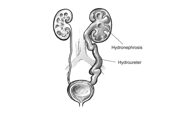 Hydronephrosis Grading Onen System Sfu Alternative Ags Comparison ...