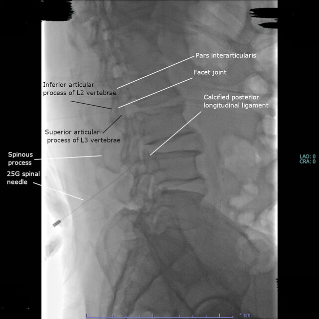 Lumbar Puncture Layers L8: Lumbar Puncture Flashcards | Quizlet