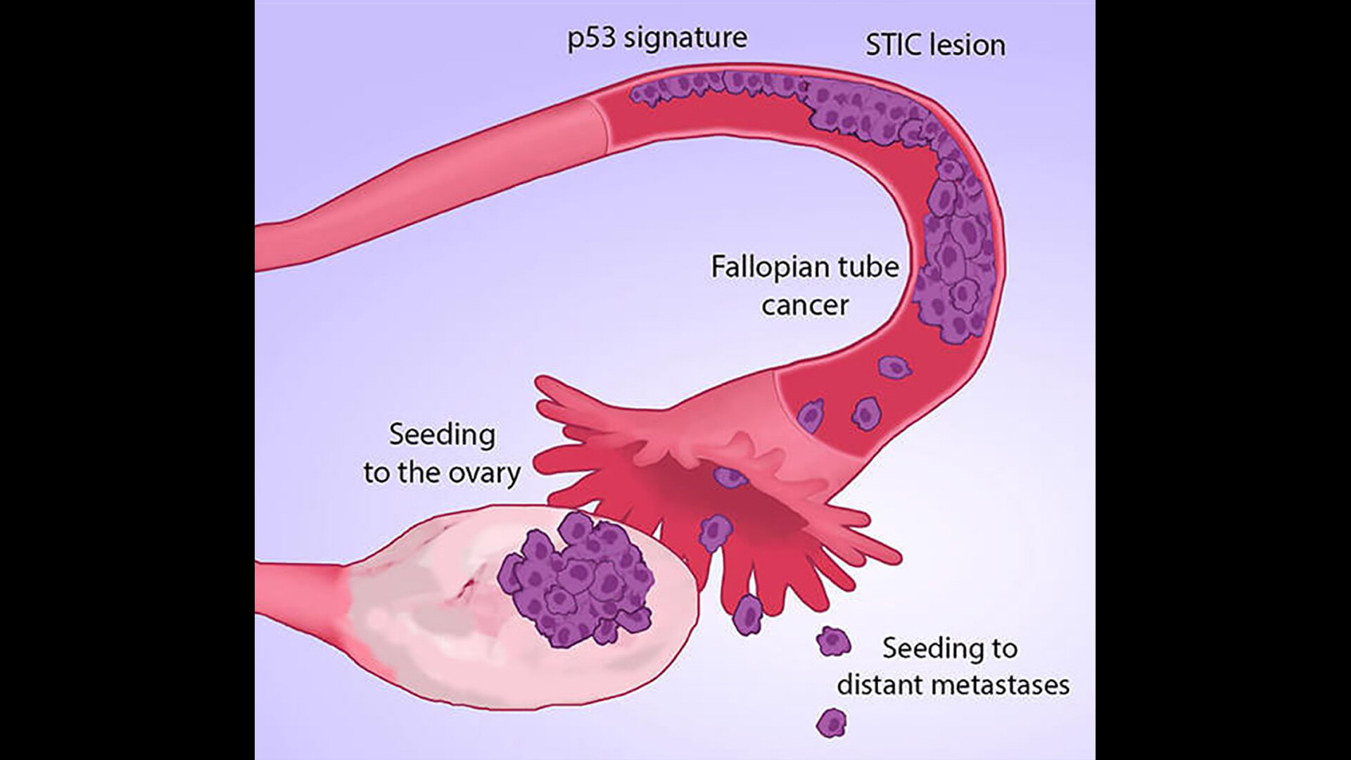 Ovary Tumor Malignant Mixed Mullerian Tumor