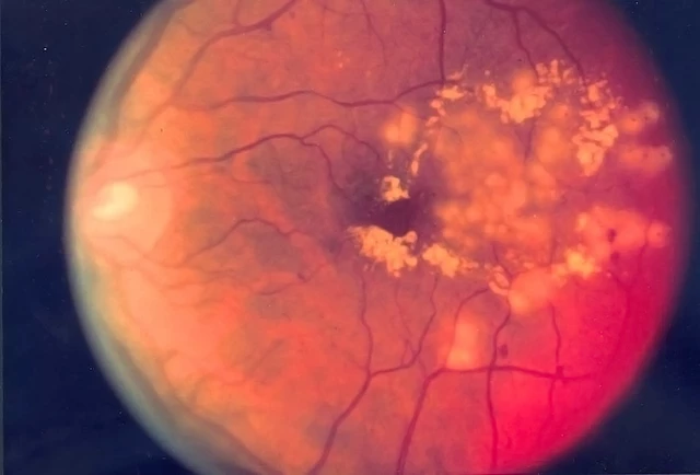 Histoplasmosis Retina Active