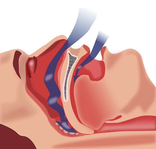 Deviated Septum Diagram How To Manage Deviated Nose: Personal Tips