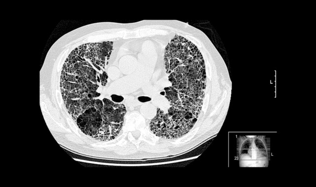 What Does Lung Scarring Look Like On Ct Scan Ct Scan Machine Imaging