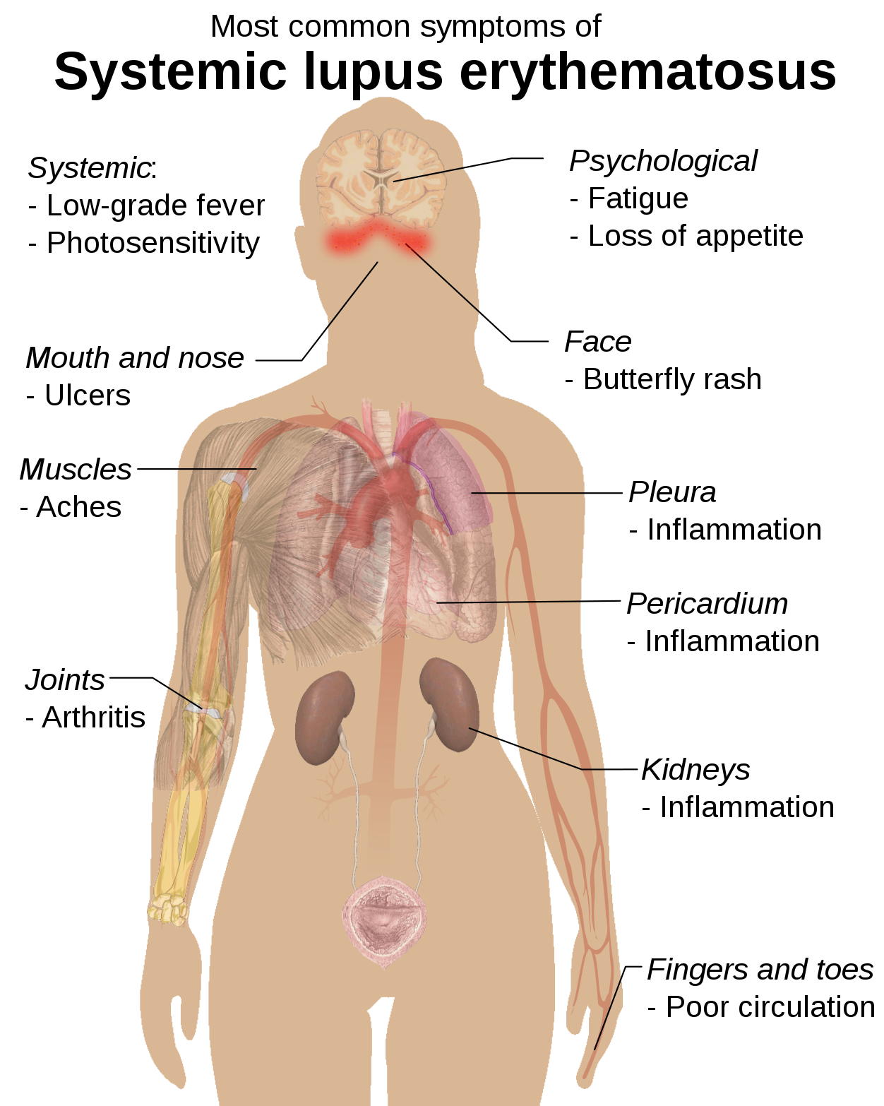 Symptoms Of Systemic Lupus Erythematosus Lupus StoryMD