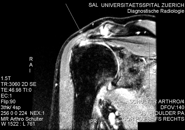 Mri Findings For Frozen Shoulder Evaluation Is The Physical Therapy In