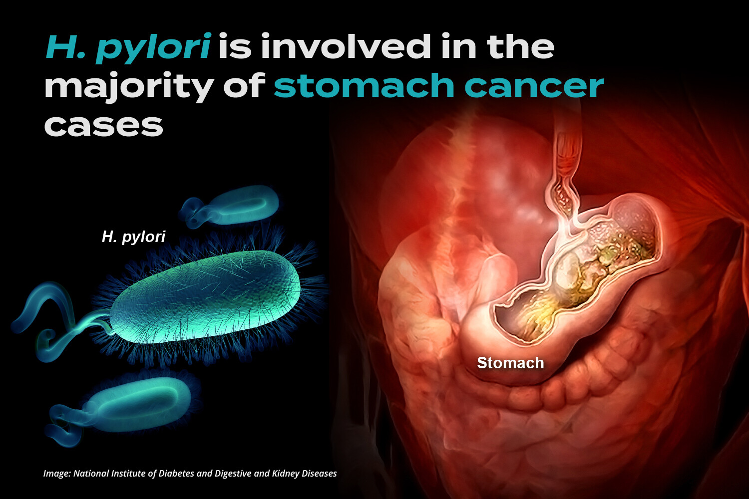 How Does Helicobacter Pylori Cause Stomach Ulcers - Infoupdate.org