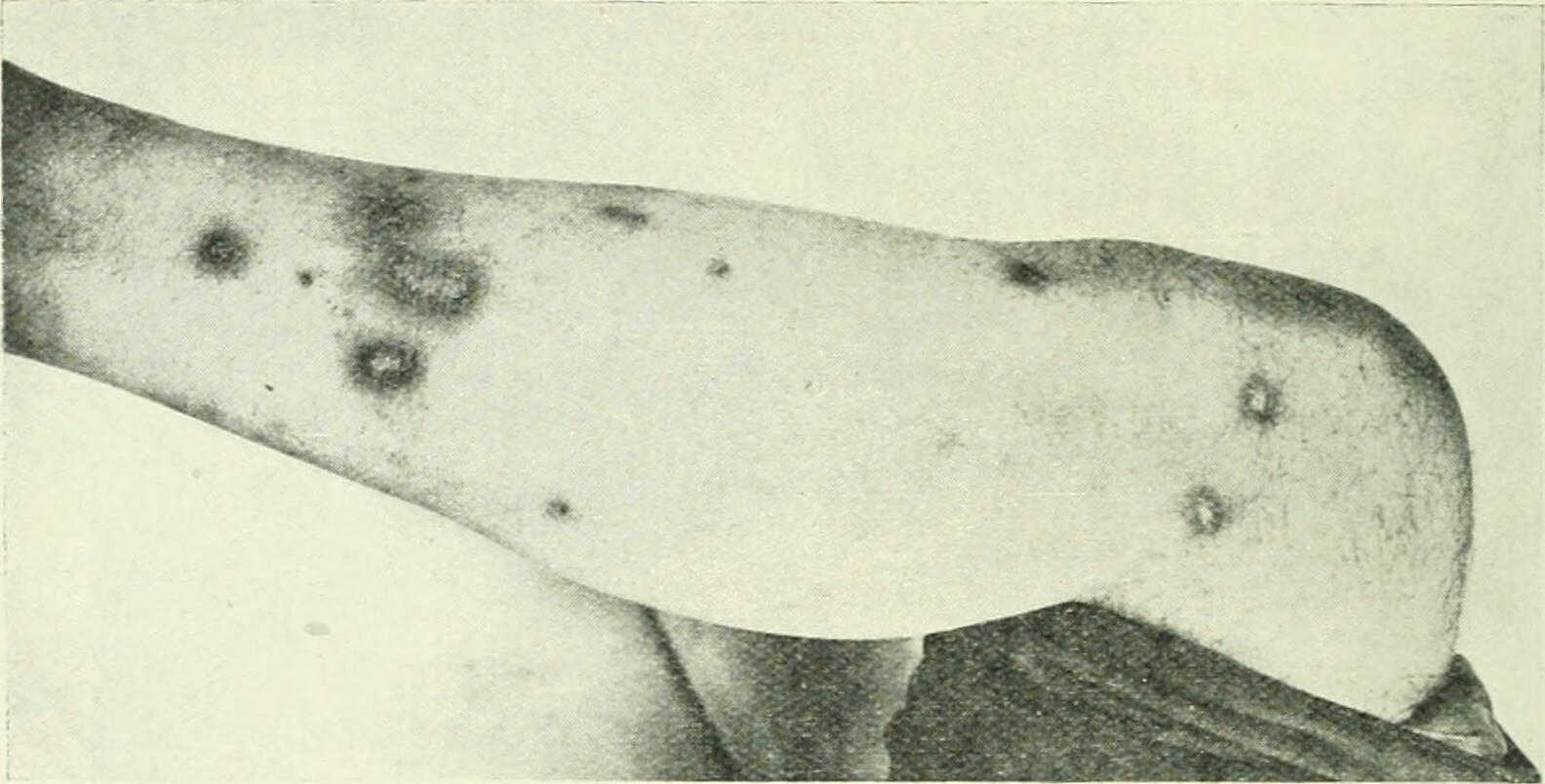 Eosinophilic Pustular Folliculitis Causes