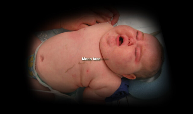 Unmasking the Moon Face to Spot Cushing’s Syndrome - StoryMD