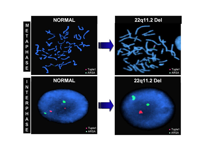 Fish Test Results Fluorescence In Situ Hybridization (FISH):