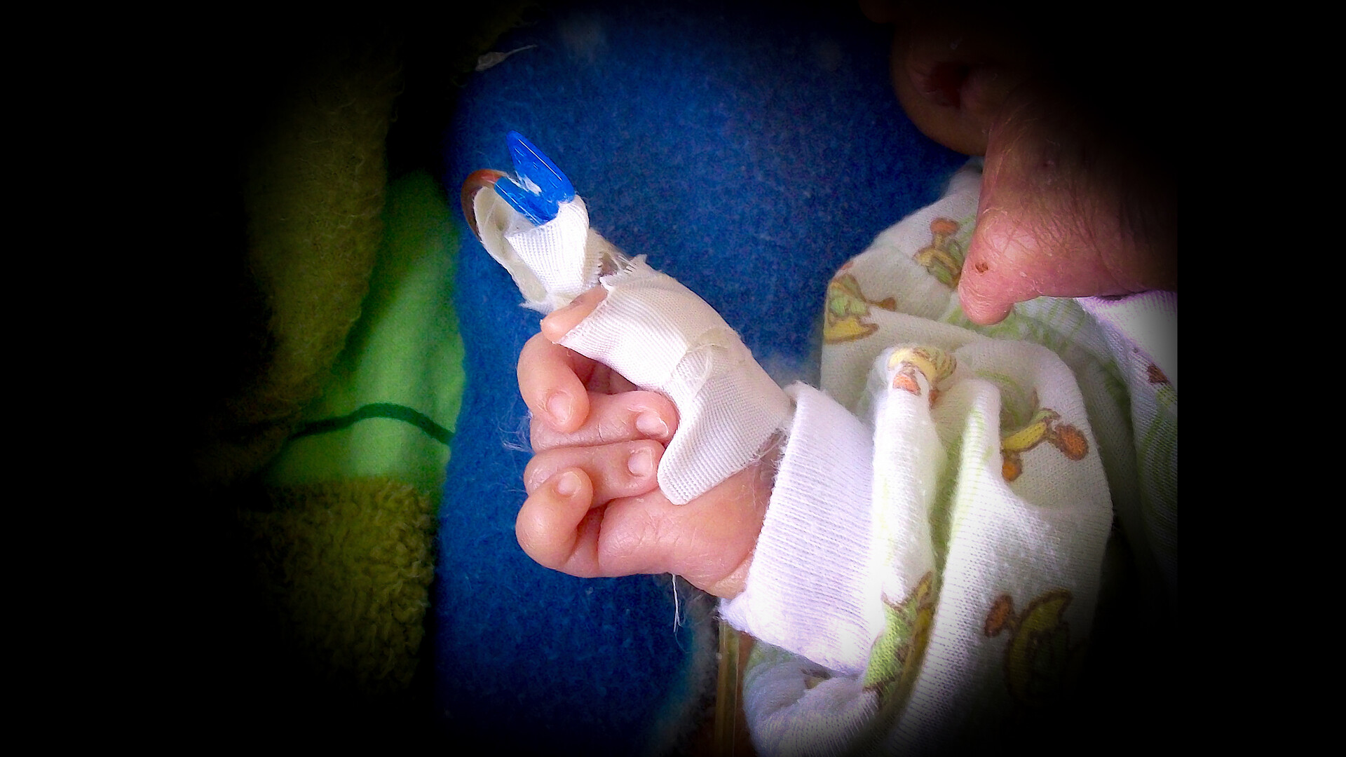 Edwards Syndrome Trisomy 18 Causes Symptoms And Types