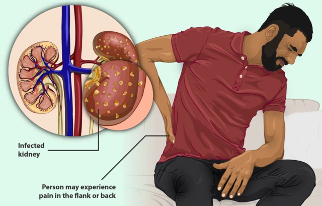 Kidney Disease Symptoms In Men Kidney Stones (Nephrolithiasis)