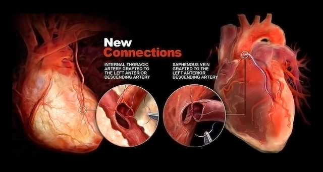 Bypass Surgery Heart Bypass Surgery: Purpose, Procedure, Risks,