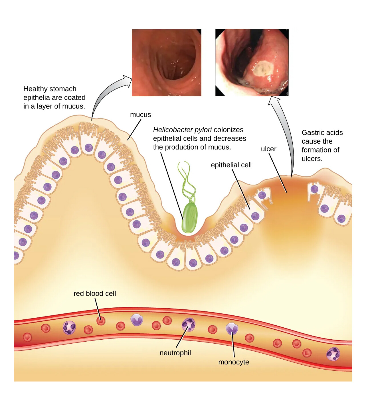 How Does Helicobacter Pylori Cause Stomach Ulcers - Infoupdate.org