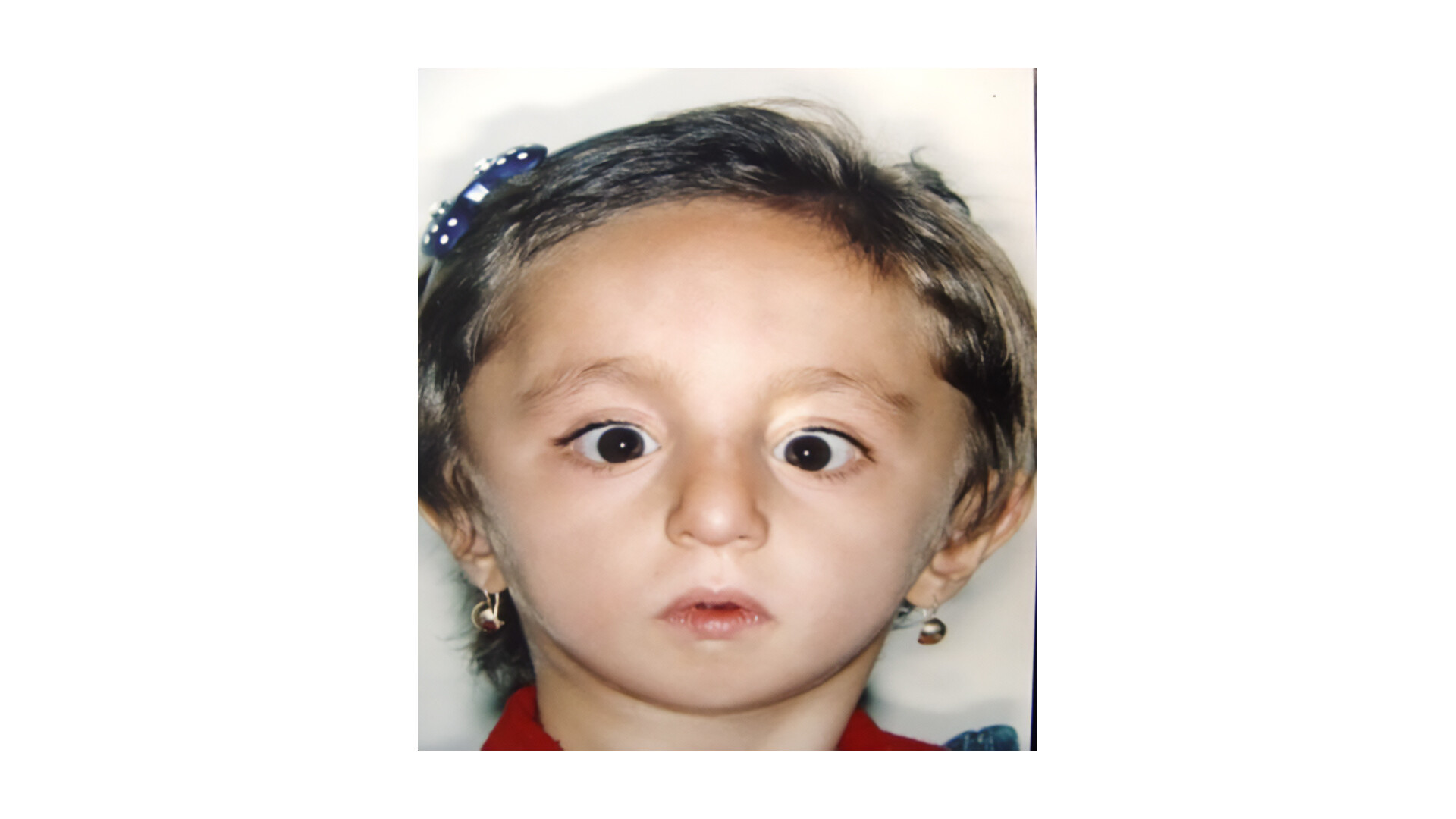 Nager Syndrome Preaxial Acrofacial Dysostosis Catania Nager Acrofacial