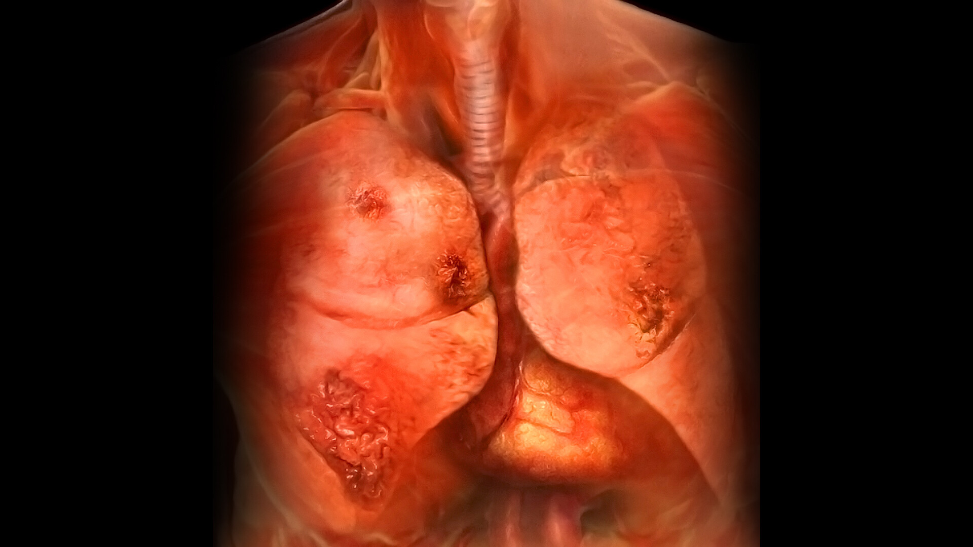 Prothrombin Time And INR Test Why Is It Done And What The Results Mean
