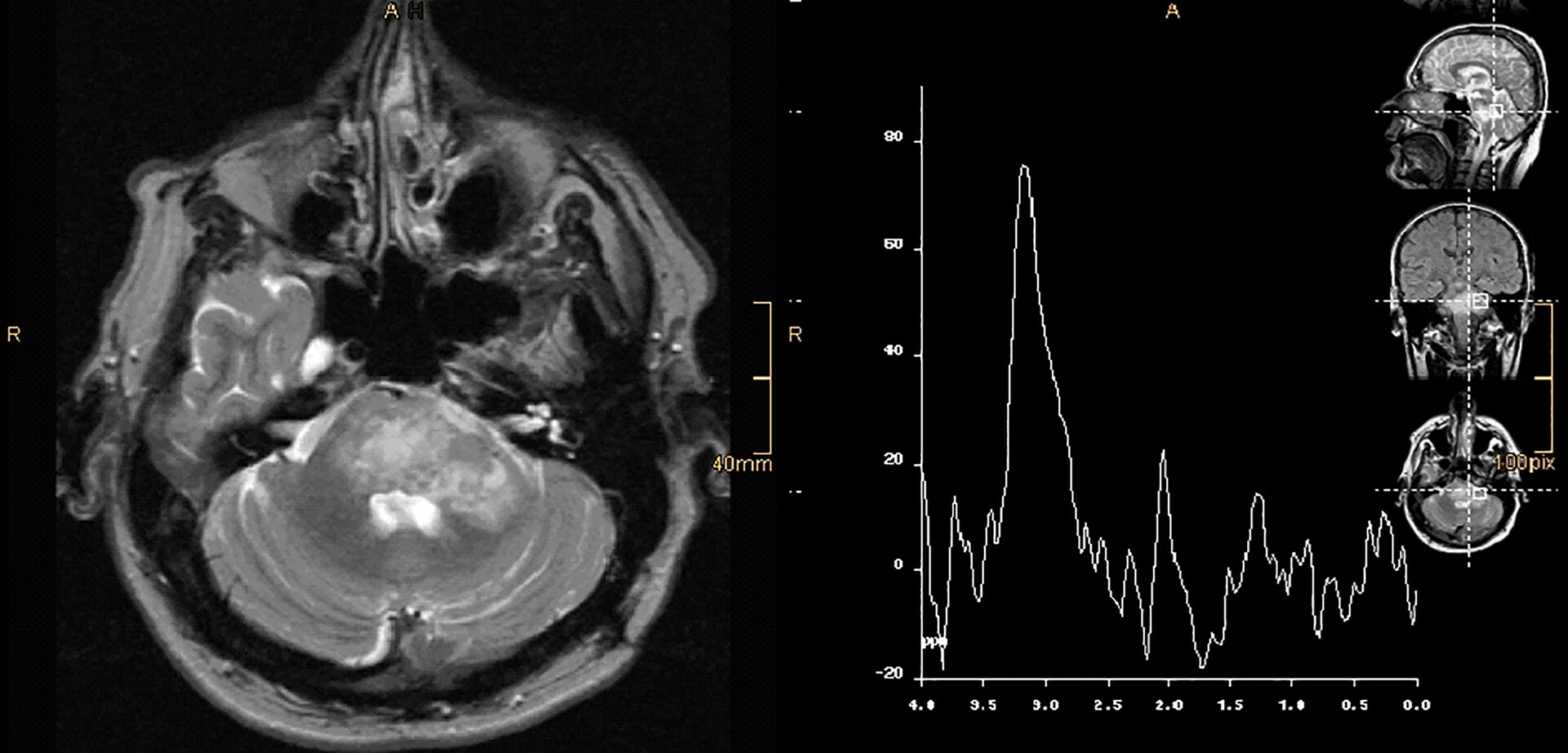 Medulloblastoma Radiopaedia