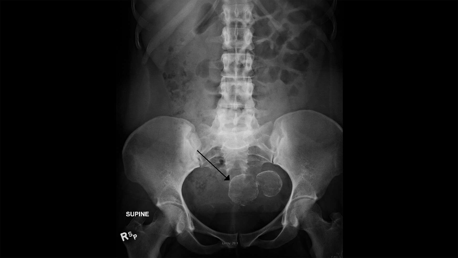 Uterine Fibroids Xray Uterine Fibroid An Overview | ScienceDirect