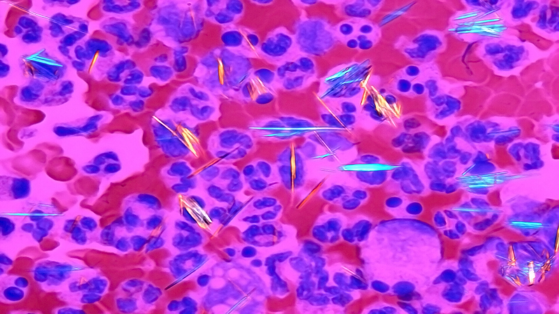 Uric Acid Crystals Polarized Crystals And Crystalloids In