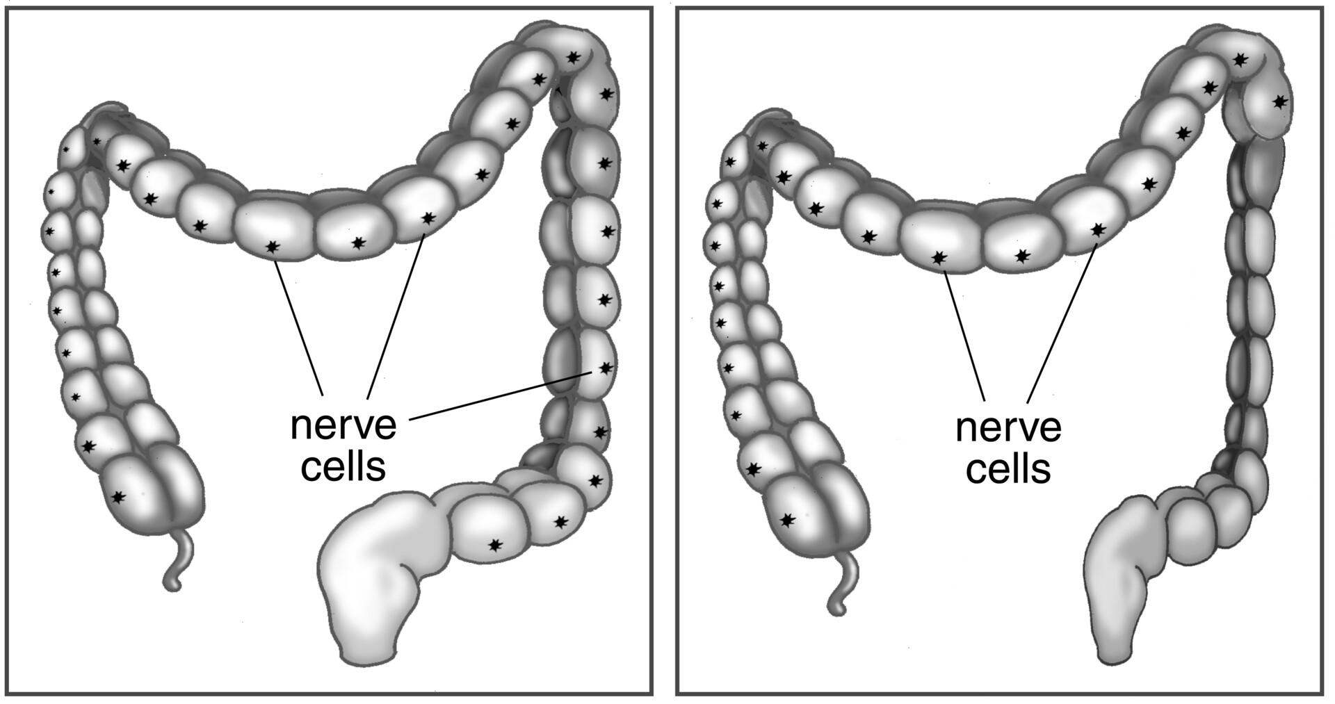 Intestinal Atresia And Stenosis