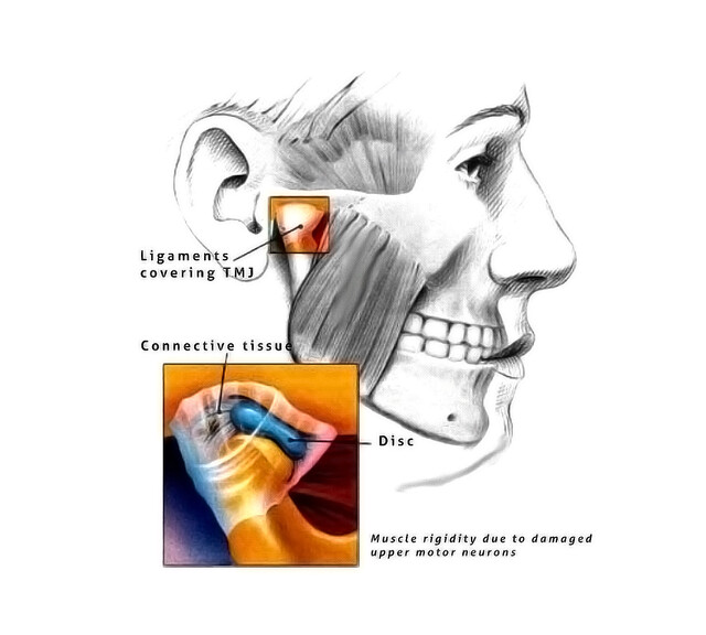 Tetanus Symptoms Diagram