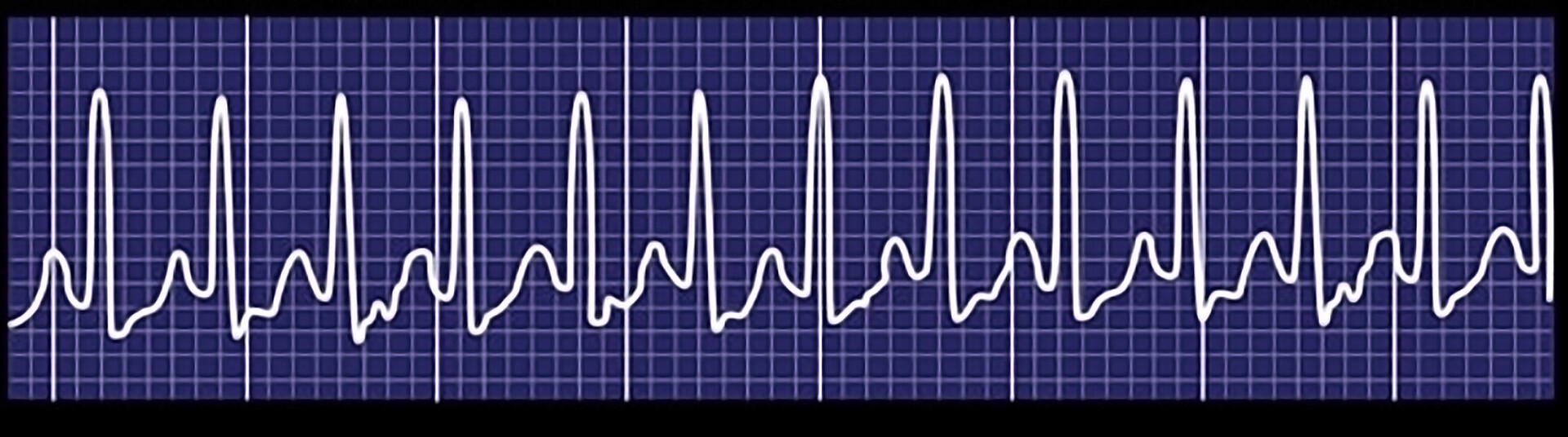 Polymorphic Ventricular Tachycardia Ventricular Tachycardia Treatment