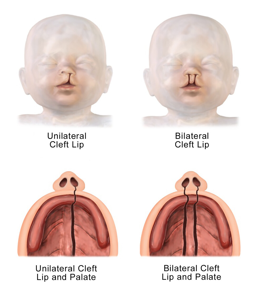 Bilateral Cleft Lip And Palate Accurate Diagnosis Of Prenatal Cleft