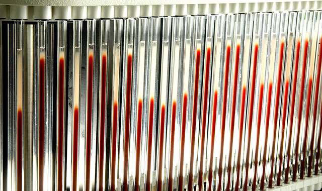 Erythrocyte Sedimentation Rate Test: Why Is It Done and What the ...