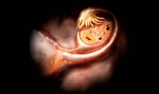 Your Ovaries and Fallopian Tubes – Friends or Foes? - StoryMD