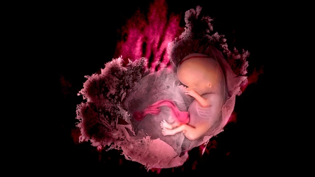Amnionbandsyndroom Early And Late Membrane / Amnion Rupture And Amnion