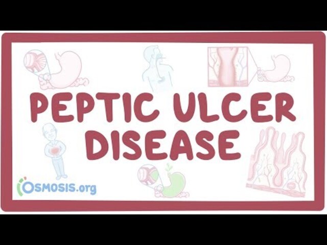 Surgical Management Of Peptic Ulcer Disease Ppt - Infoupdate.org