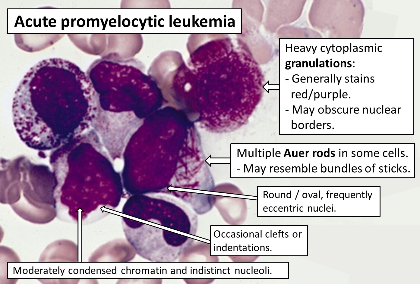 Acute Promyelocytic Leukemia Acute Leukemias In Adults | Oncohema Key