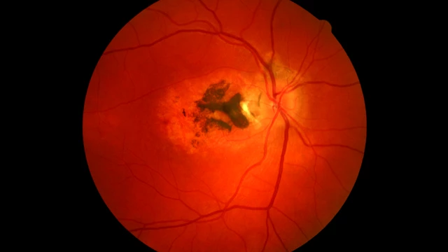 Toxocara Canis Eye Retinal Vasculitis In Toxocara Canis Neuroretinitis