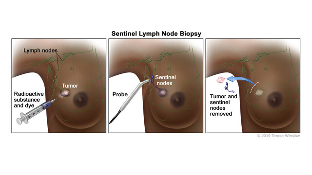 Lymph Node Biopsy Sentinel Lymph Node Biopsy For Melanoma And Surgical
