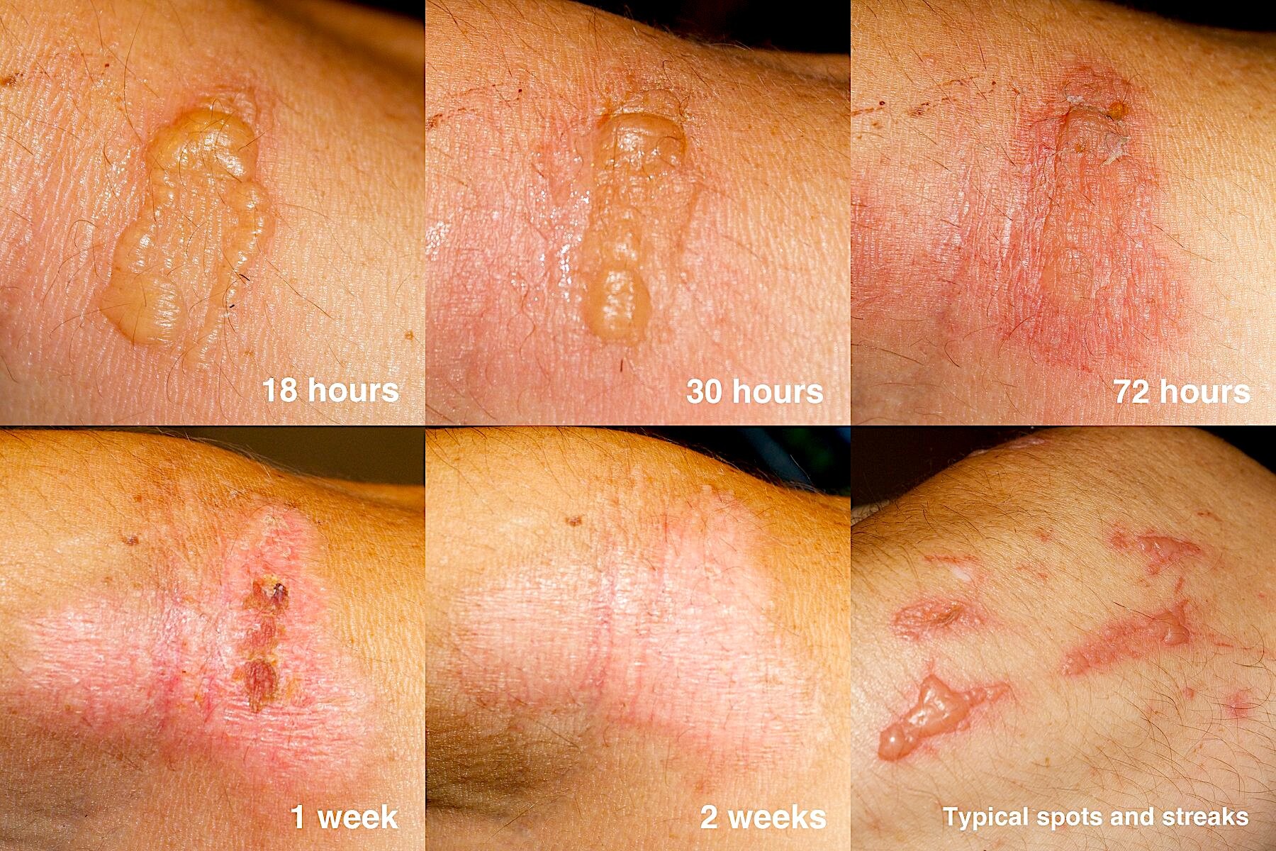 Poison Oak Rash Vs Poison Ivy Recognizing Poison Ivy, Oak And Sumac