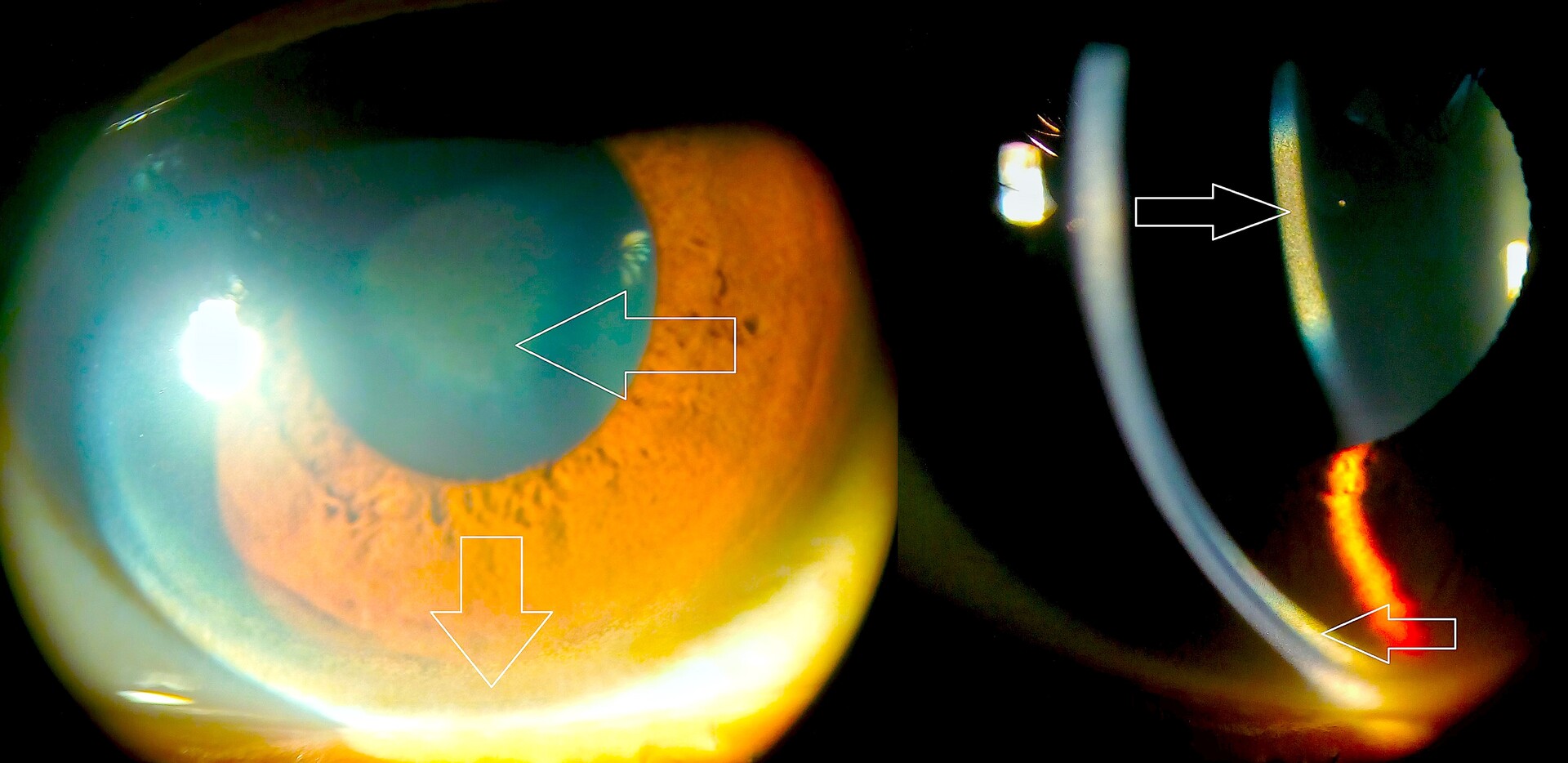 Sunflower Cataract Clear Up Cataract Concerns