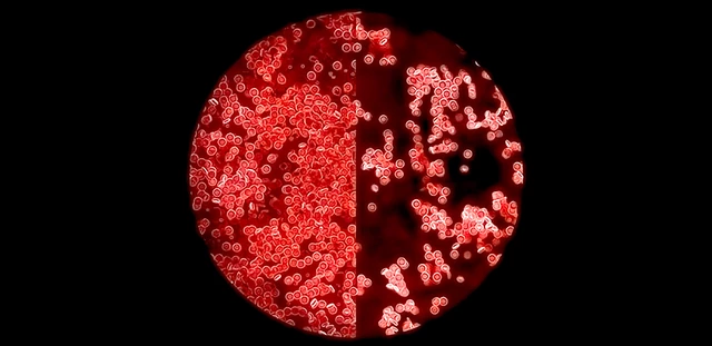 Iron Deficiency Anemia Under Microscope 86 Microcytic Hypochromic