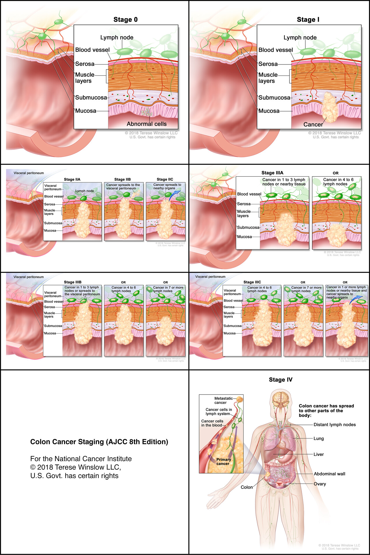 Rectal Cancer Staging Rectal Cancer: Symptoms, Causes And Stages | Max