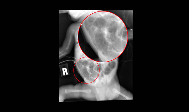 Enterocolitis Symptoms Causes Diagnosis Treatment Hay Fever (Rhinitis ...