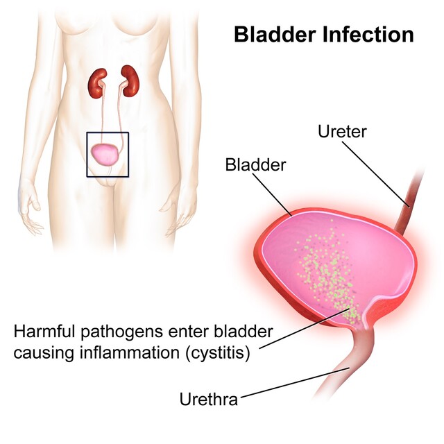 Urinary Tract Infection Armando Hasudungan Pregnancy (not A Disease)