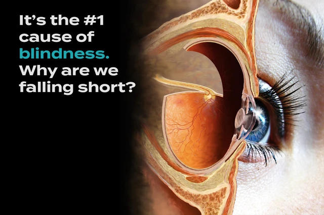 Cataract Blindness Through Their Perspective Cataract Surgery: