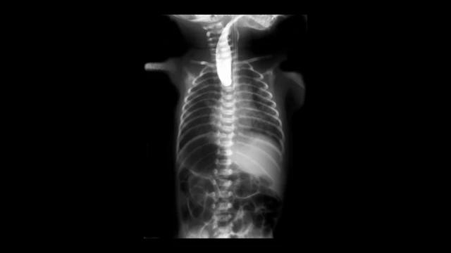 Tracheoesophageal Fistula Barium Swallow