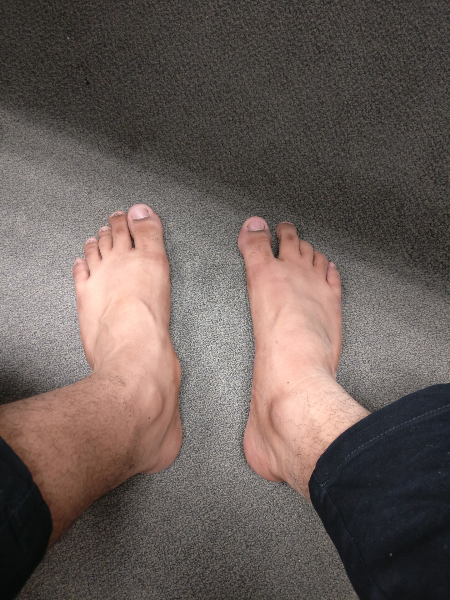 Accessory Navicular A) Image Of Right Foot Showing Localized Erythema